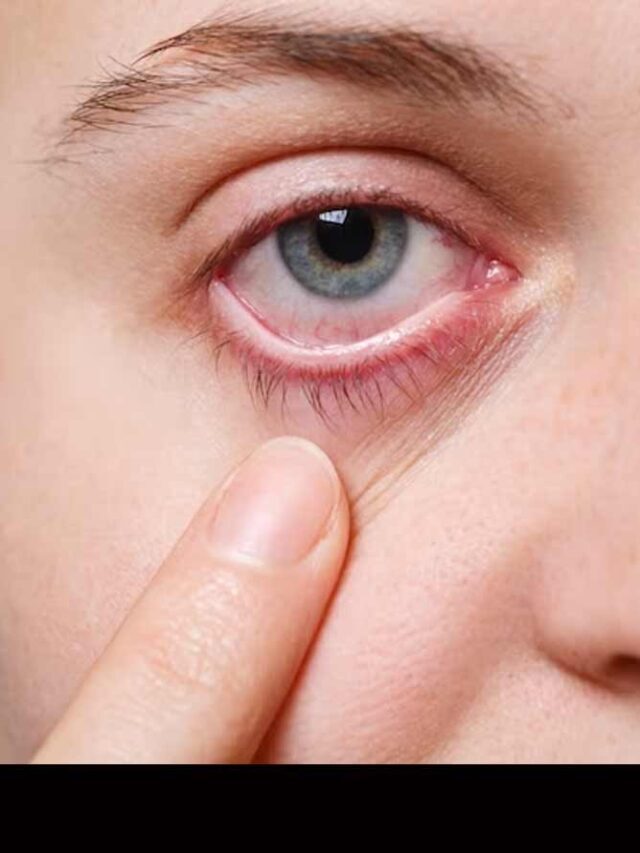Conjunctivitis Pink Eye Symptoms Treatment And Prevention Sehat