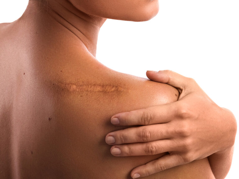 Effective Home Remedies to Reduce Stitch Marks After Surgery | Sehat ...