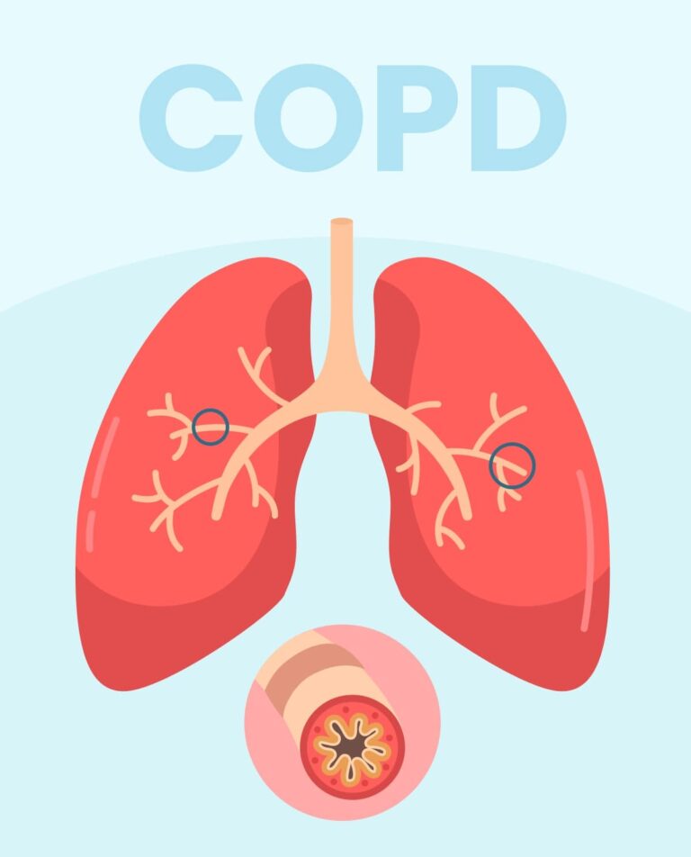 Understanding and Preventing COPD: Risks from Air Pollution and ...