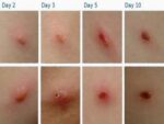 Understanding the Stages of Chickenpox: Symptoms, Progression, and ...