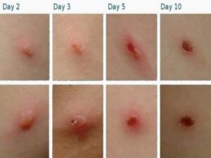 Understanding the Stages of Chickenpox: Symptoms, Progression, and Recovery | Sehat Tak Health News