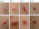 Understanding the Stages of Chickenpox: Symptoms, Progression, and ...